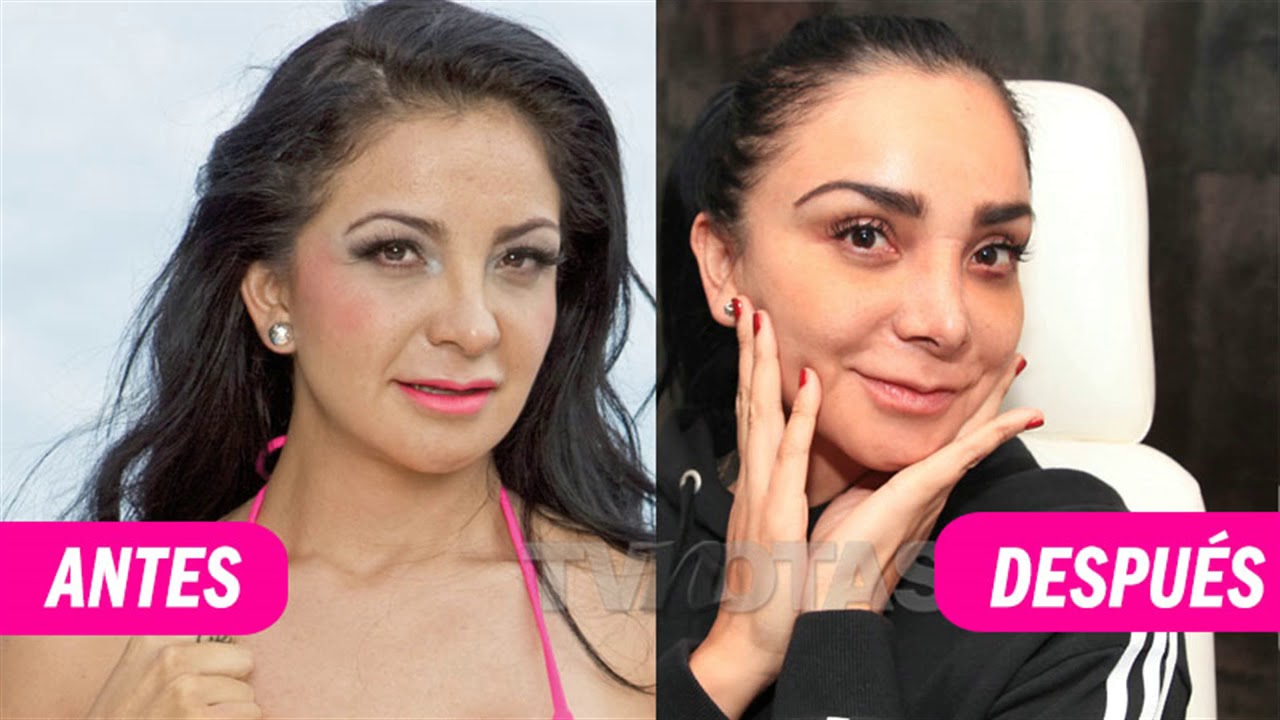 Así luce la nueva nariz de La Wanders Lover ¡tras su tercera cirugía ...