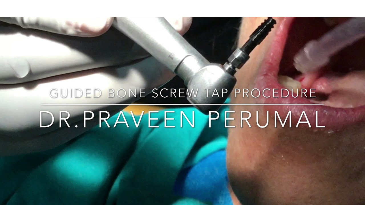 Pre tapping procedure for dental implant placement - YouTube