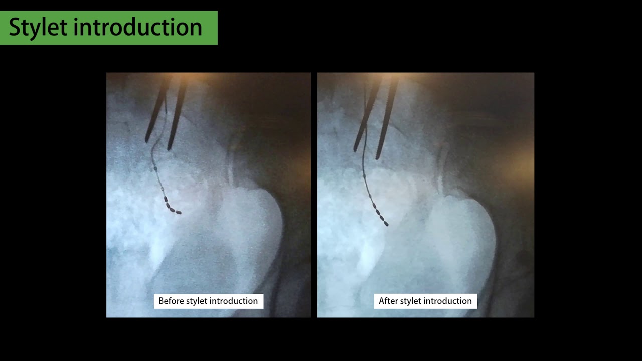 ICS 2020 Abstract #615 Removal of Interstim tined-lead using straight ...