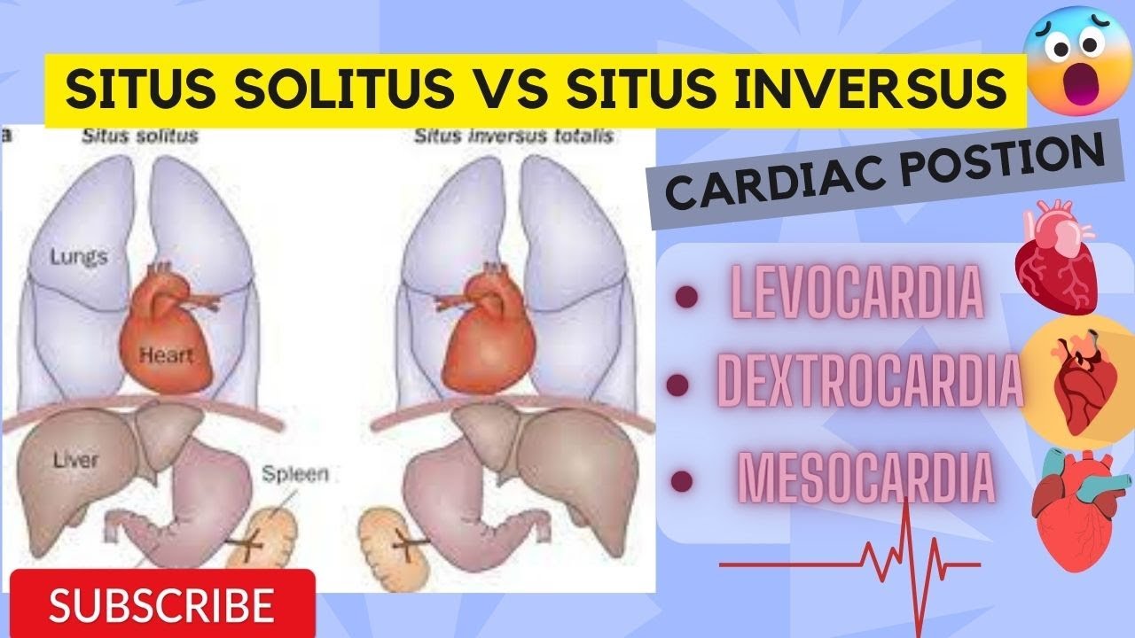 Situs Solitus Dextrocardia With Sinus Solitus | CMAJ
