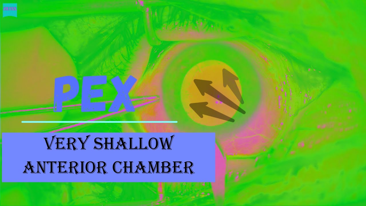 PEX Cataract and Shallow AC - YouTube