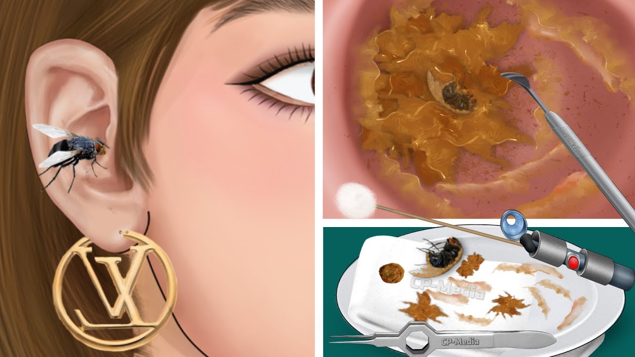 ASMR The best treatment and remove flies and slimes in girls' ears | 실감 ...