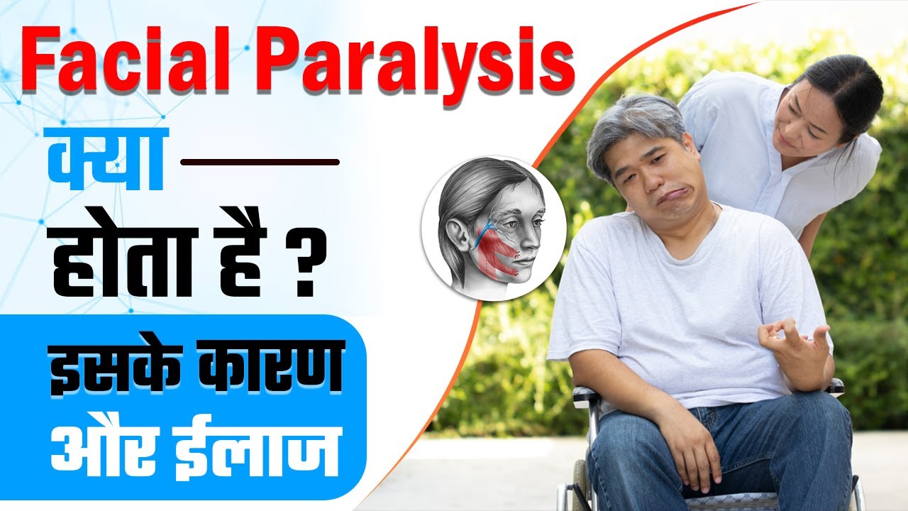 Facial Paralysis क्या होता है? | What is Facial Paralysis? | Facial ...