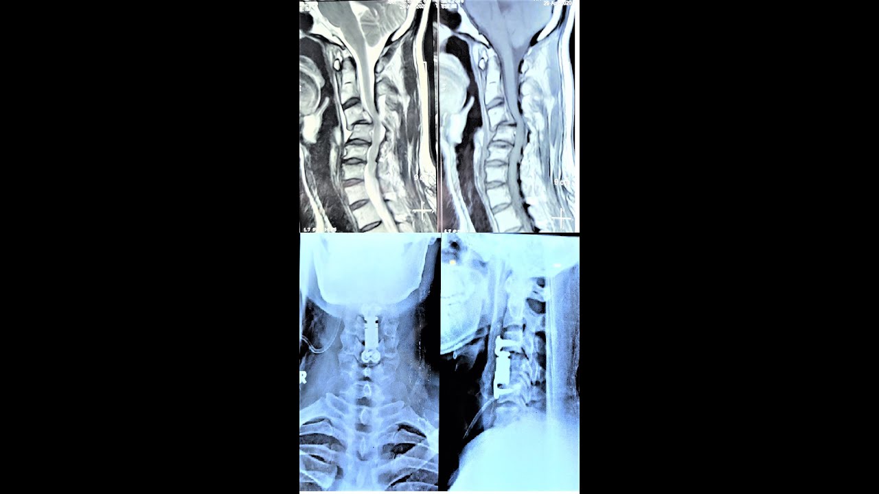 CERVICAL SPINE FRACTURE DISLOCATION C4-5, C4 BODY CORPECTOMY ...