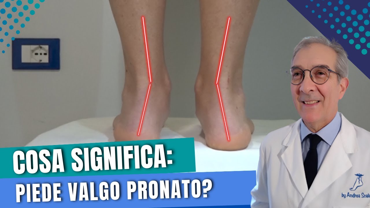 Piede pronato valgo: Il "FALSO PIEDE PIATTO" | Come riconoscere il ...