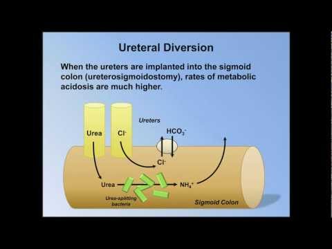 How Does Diarrhea Cause Non Anion Gap Metabolic Acidosis