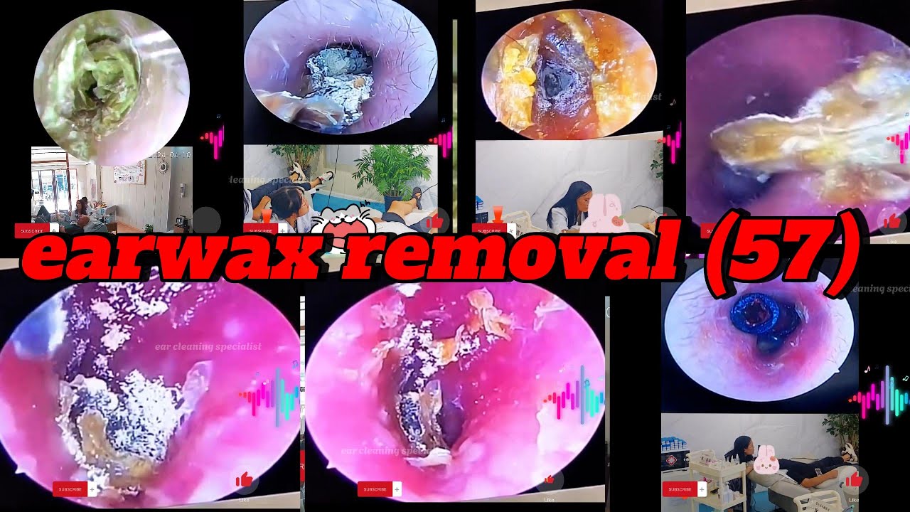 ASMR | ABSURDLY Satisfying Earwax Removal !!! - YouTube