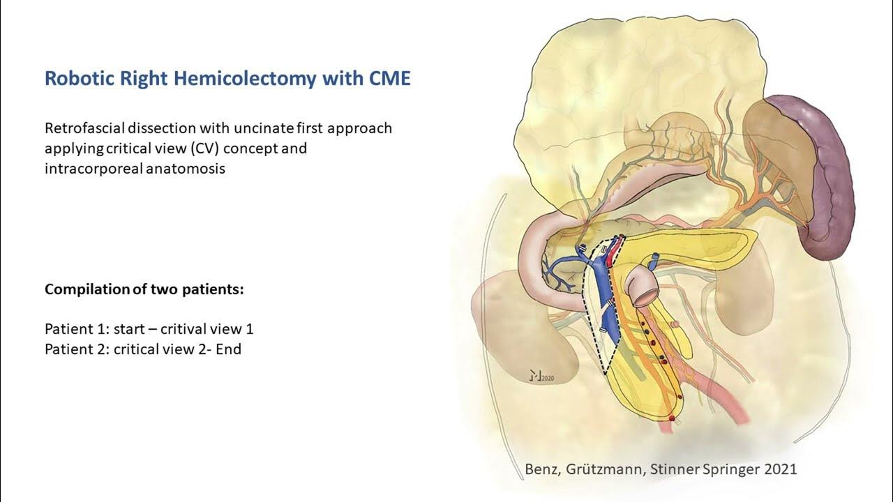 Robotic right hemicolectomy with CME and critical view concept (narrated) - YouTube