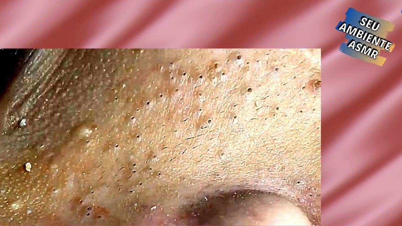 Retirando cravos e espinhas no rosto | acne treatment | vídeo ...