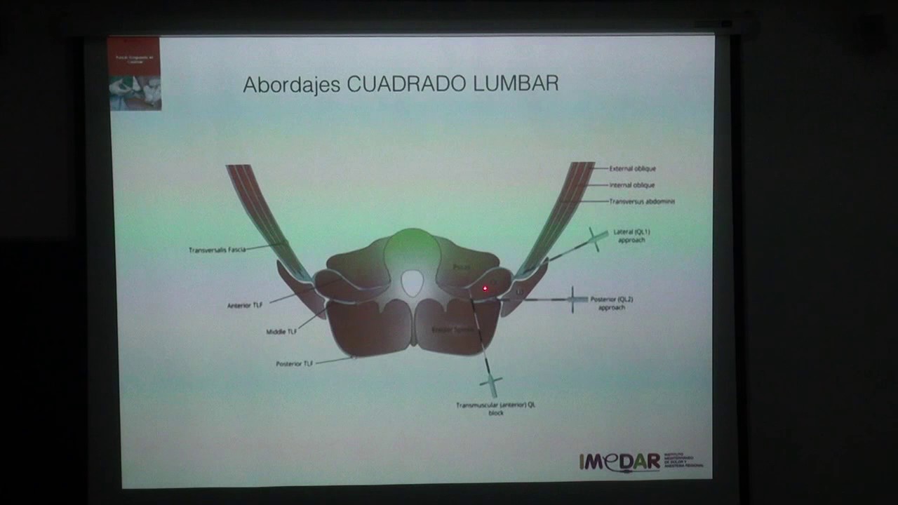 MUSCULO CUADRADO LUMBAR. DR CARLOS TORNERO - YouTube