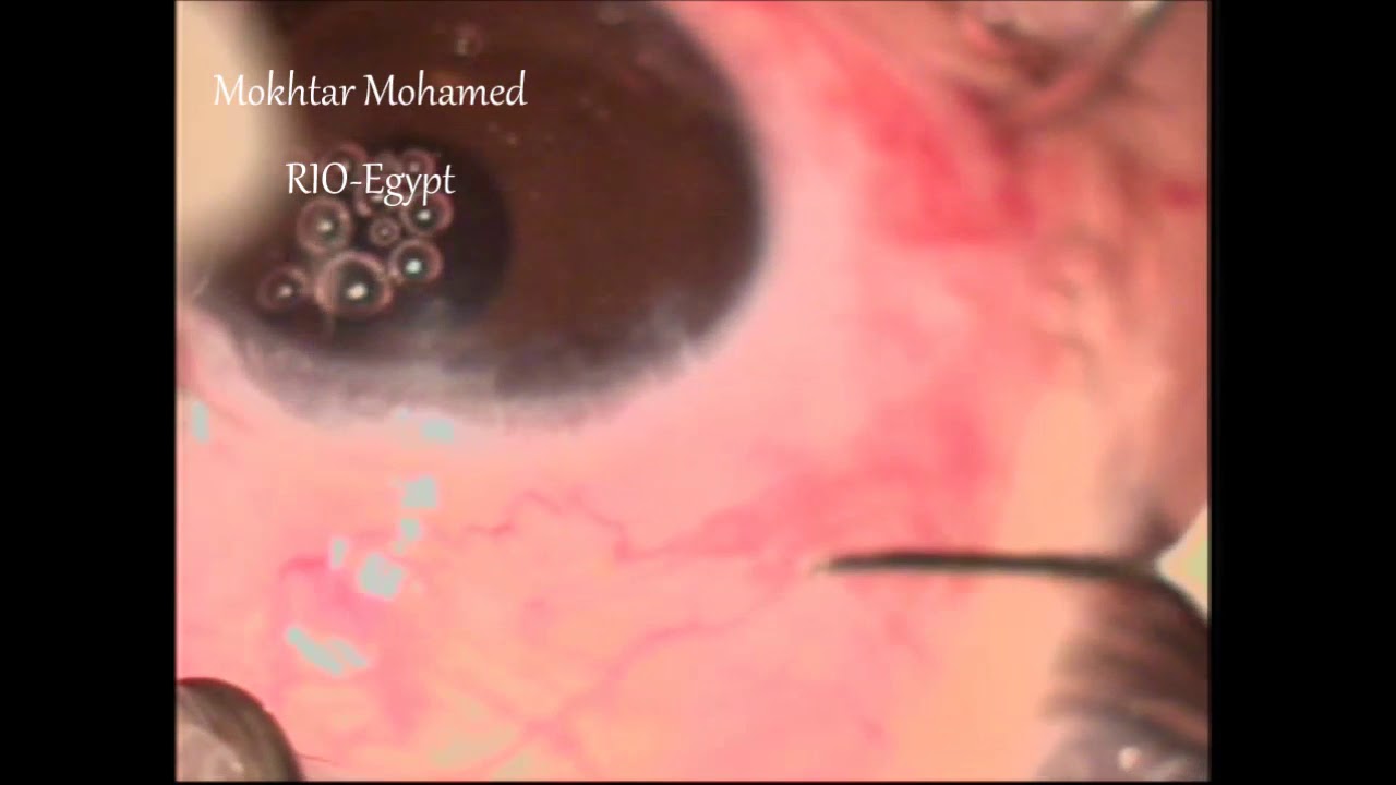 Bleb needling - YouTube