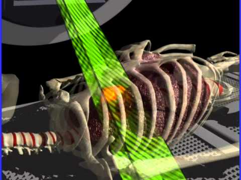 Trilogy Respiratory Gating System (2) - YouTube