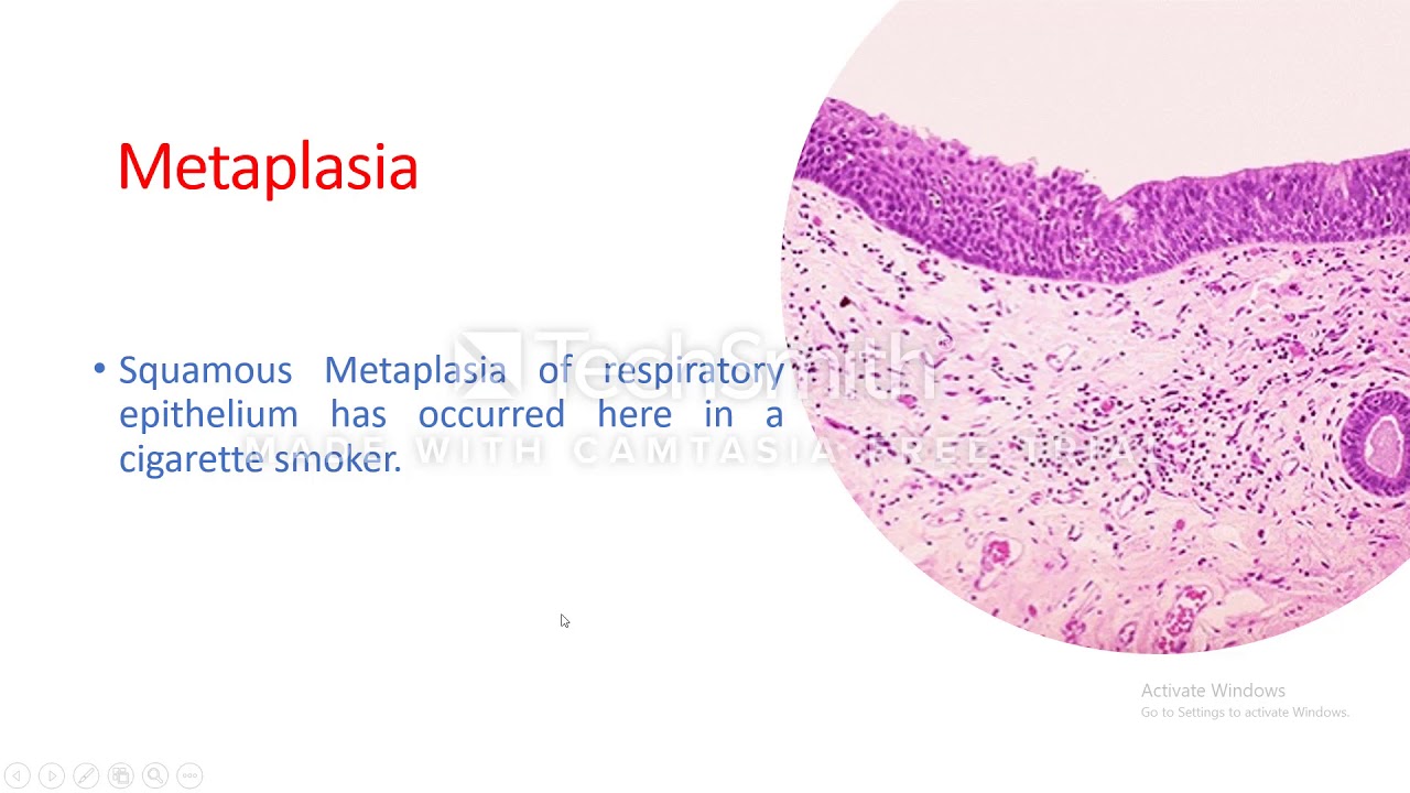 Cellular adaptation Metaplasia - YouTube