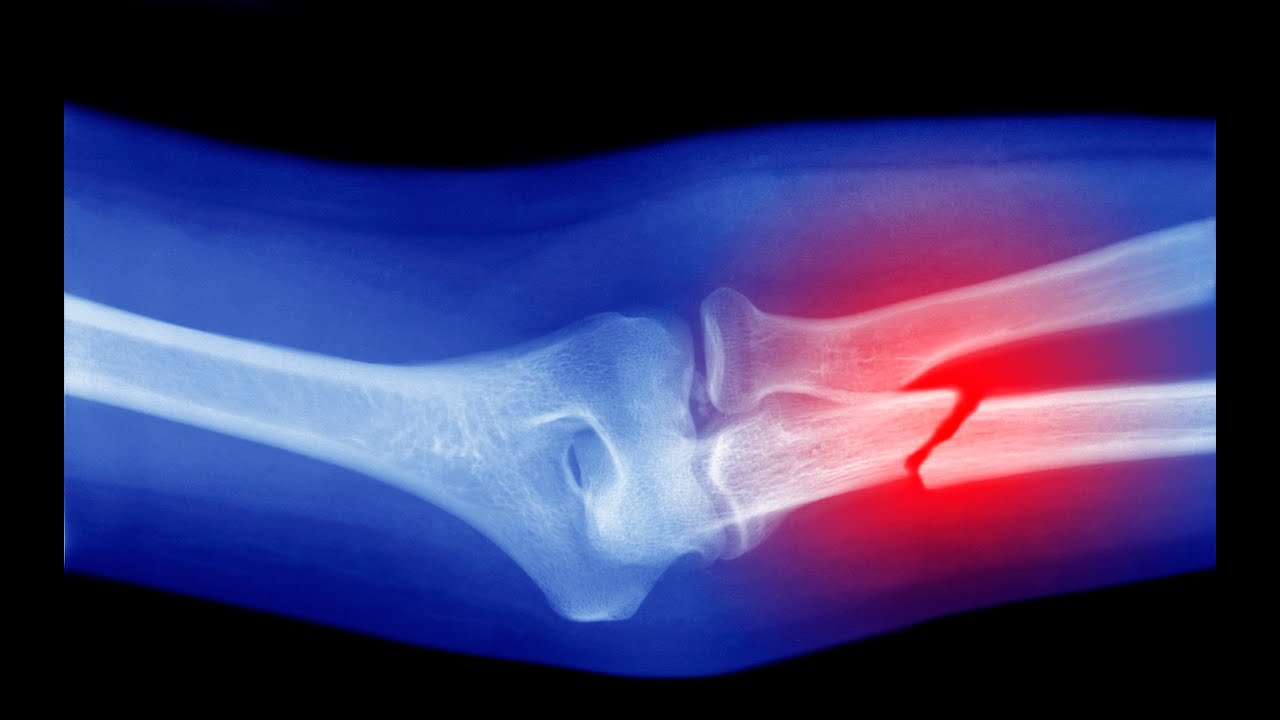 BRAKING EVERY BONE!!!! - YouTube