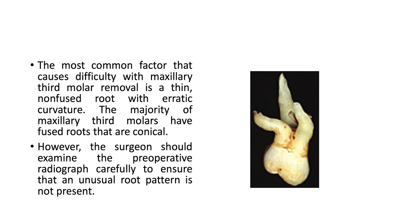 classification systems of maxillary third molar impaction - YouTube