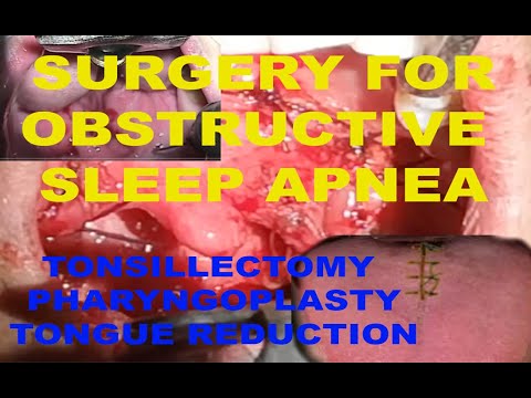 SURGERY FOR OBSTRUCTIVE SLEEP APNEA AND SNORING WITH UVULA PRESERVATION ...