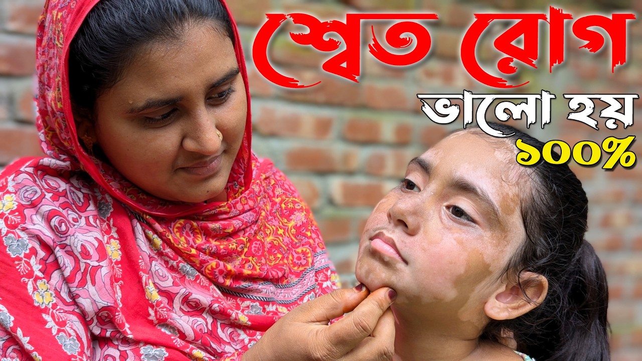 আলহামদুলিল্লাহ মাওয়ার শ্বেত রোগ ভালো হচ্ছে | শ্বেতী | Traditional Life ...