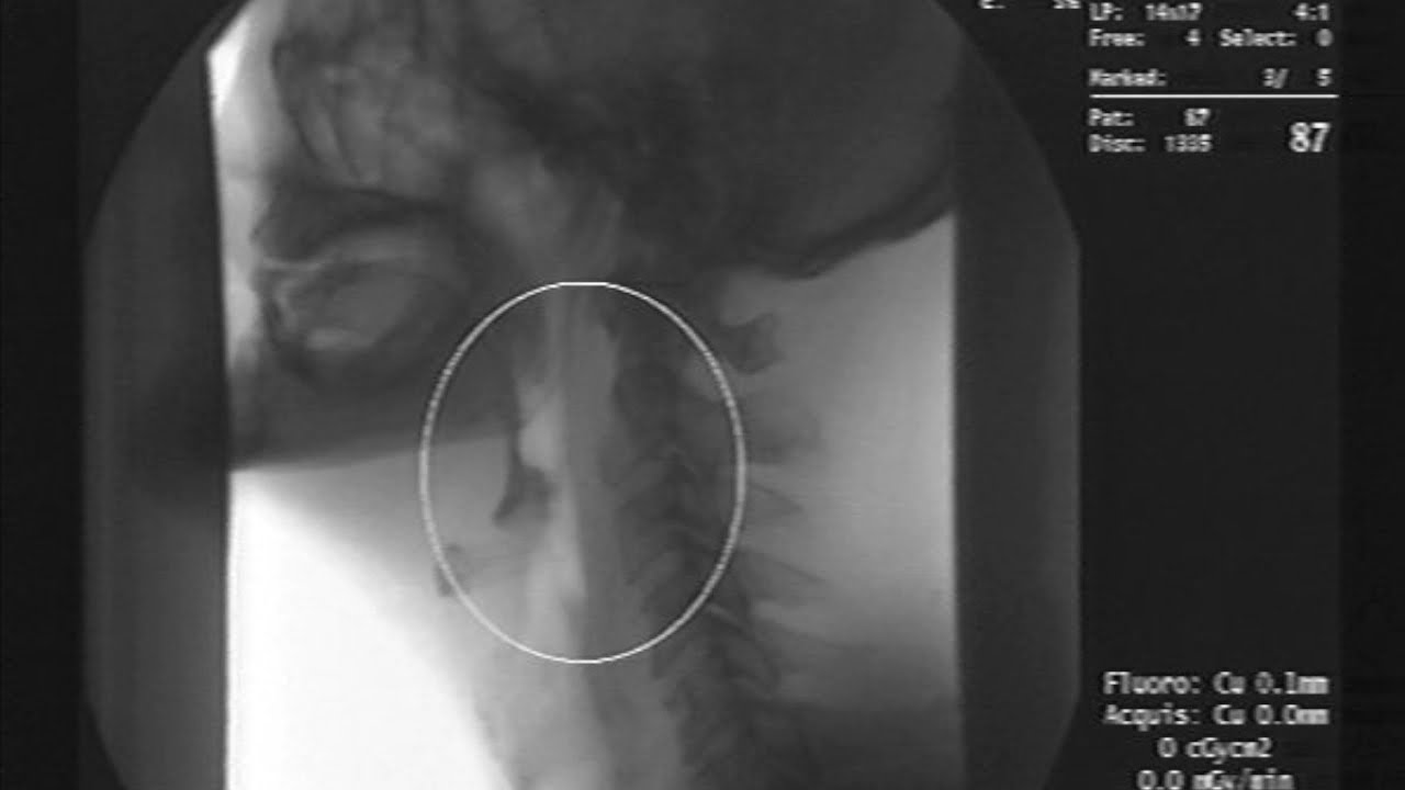 Modified Barium Swallow Assessment
