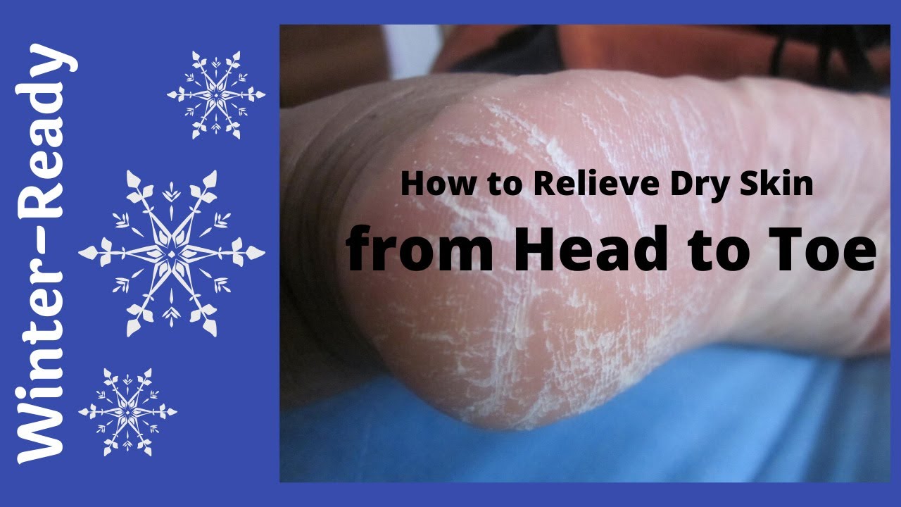 How to Treat Cracked Feet: Dry Skin Relief From Head to Toe | Daily ...