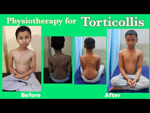 Torticollis Physiotherapy treatment/Wry Neck Exercises/ Torticollis ...