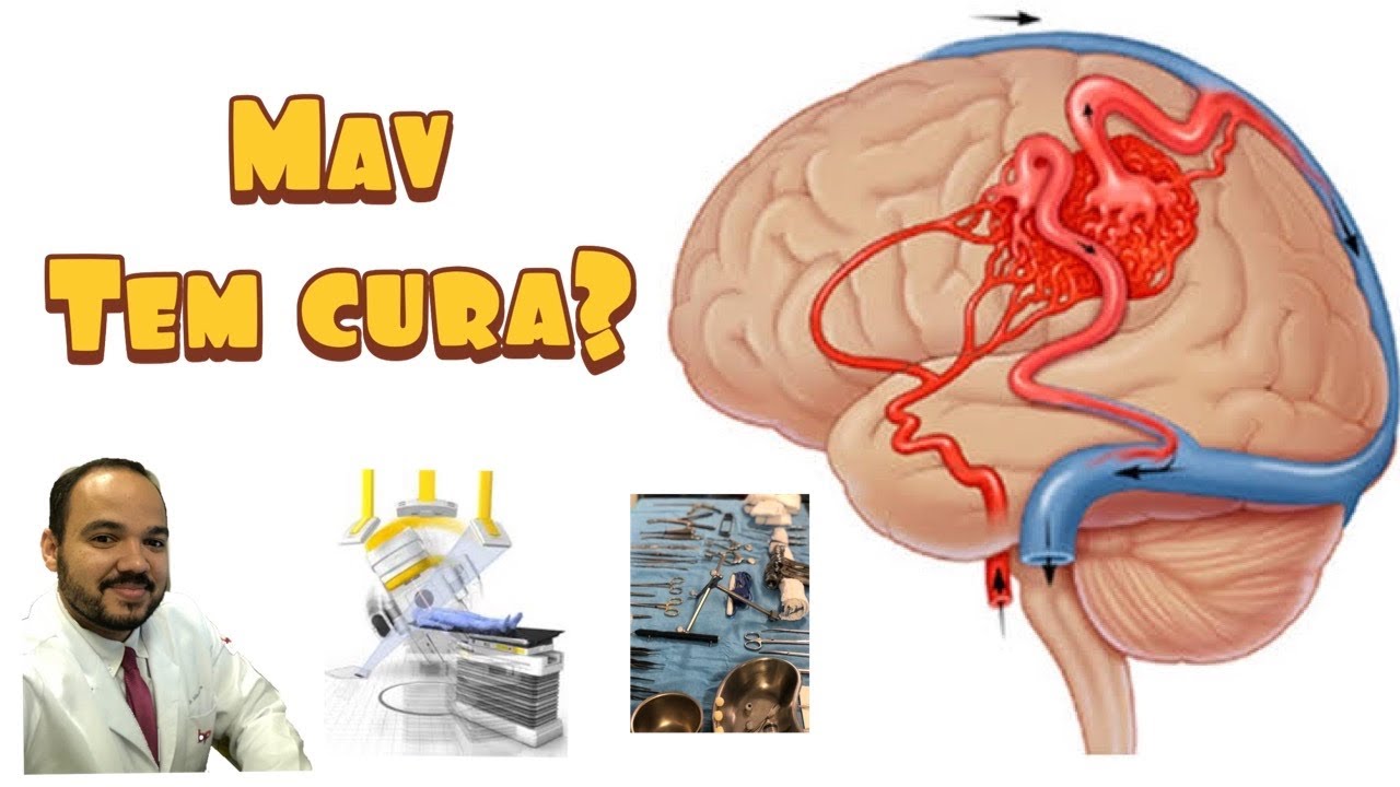 Valor De Cirurgia De Mav - RETOEDU