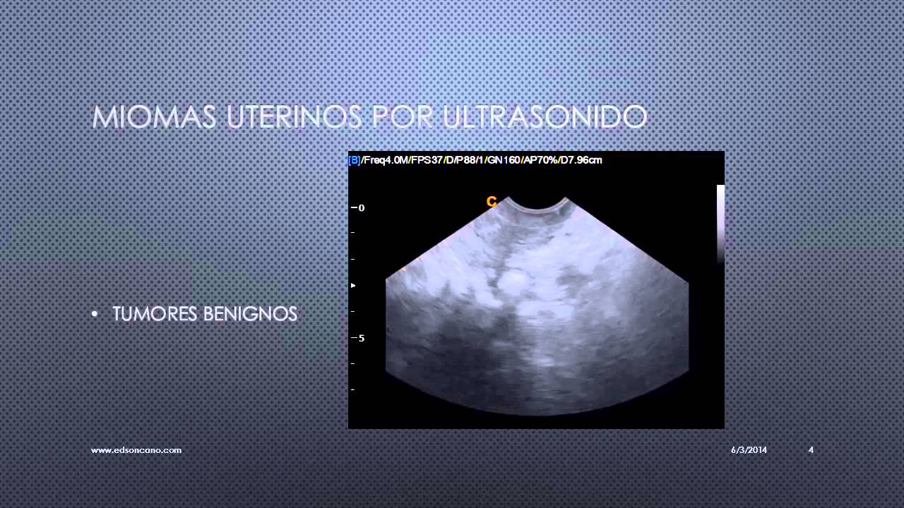 MIOMAS UTERINOS VISUALIZADOS POR ULTRASONIDO - YouTube