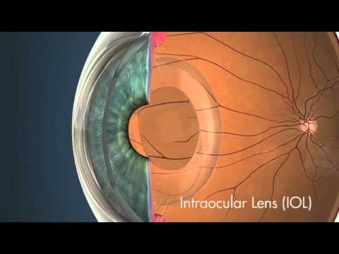 Correct your Cataracts with Crystalens® - MedStar Health - YouTube