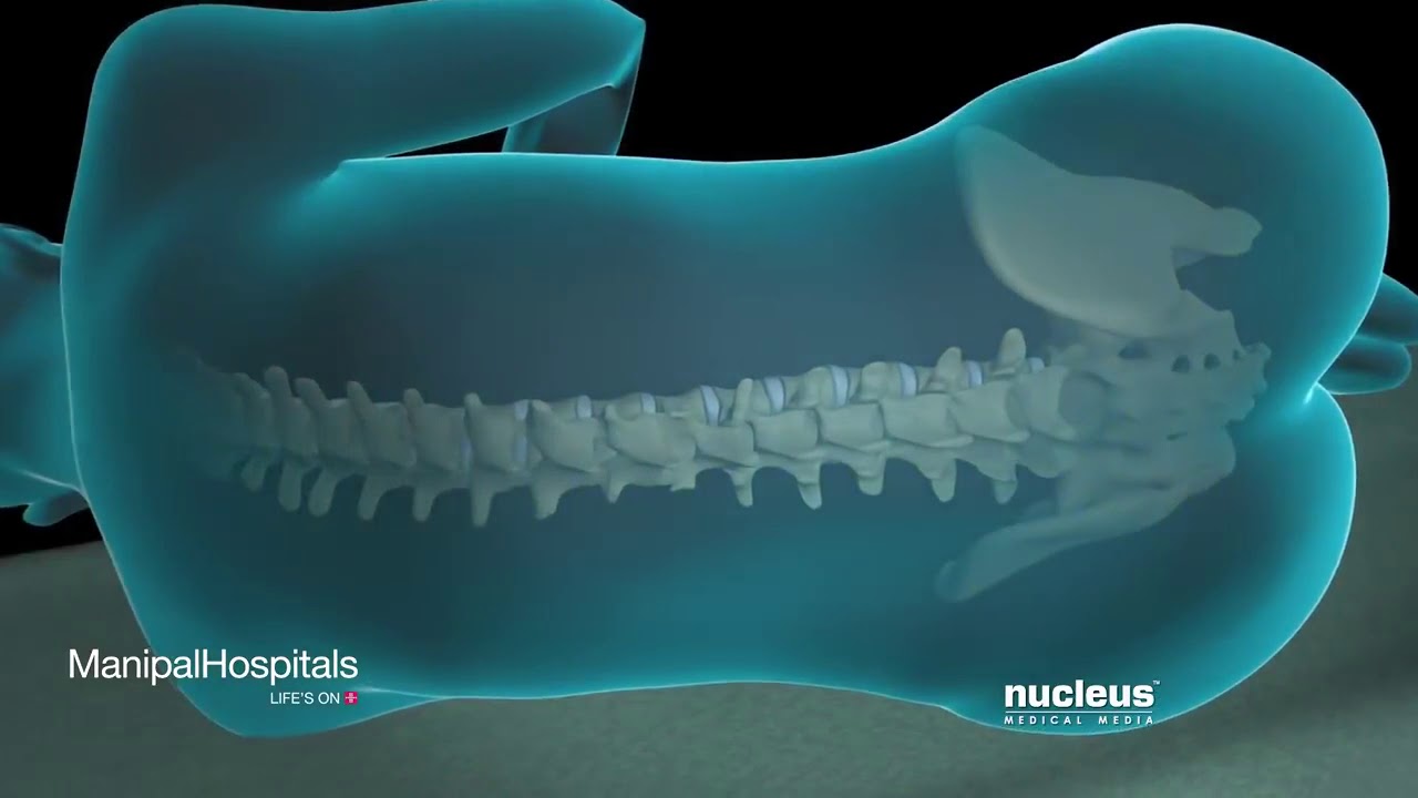 Explain Spinal And Epidural Anesthesia Process Of Injecting General ...
