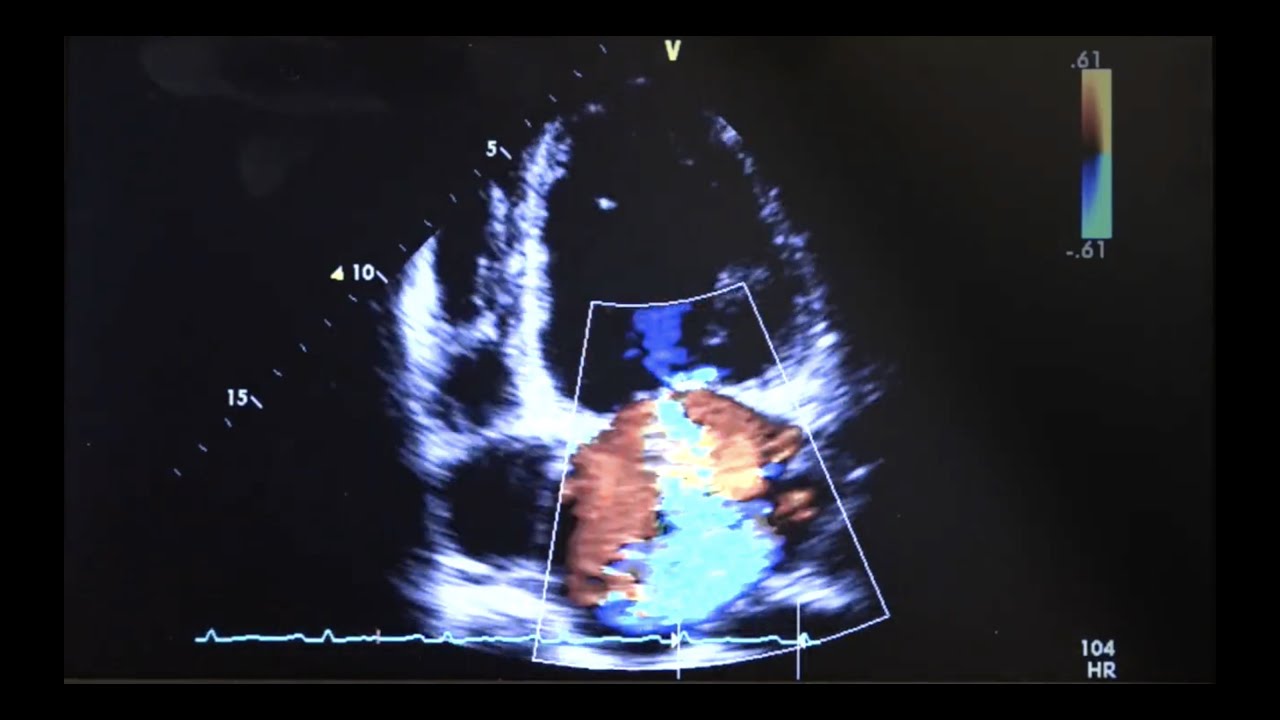 COVID-19 Basic Echocardiography - How to do POCUS for COVID-19 - YouTube