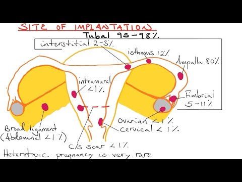 Ectopic pregnancy | Methotrexate indications | - YouTube