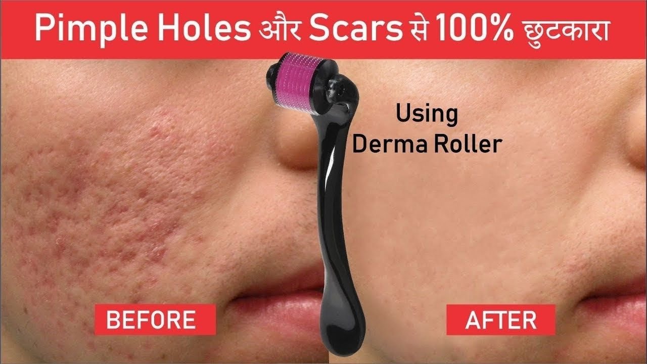 How I Tried Derma Roller On My Face Part -1 | Demo + Review | चेहरे के ...
