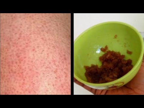 How To Get Rid Of Chicken Skin/Keratosis Pilaris Remedy😮 - YouTube