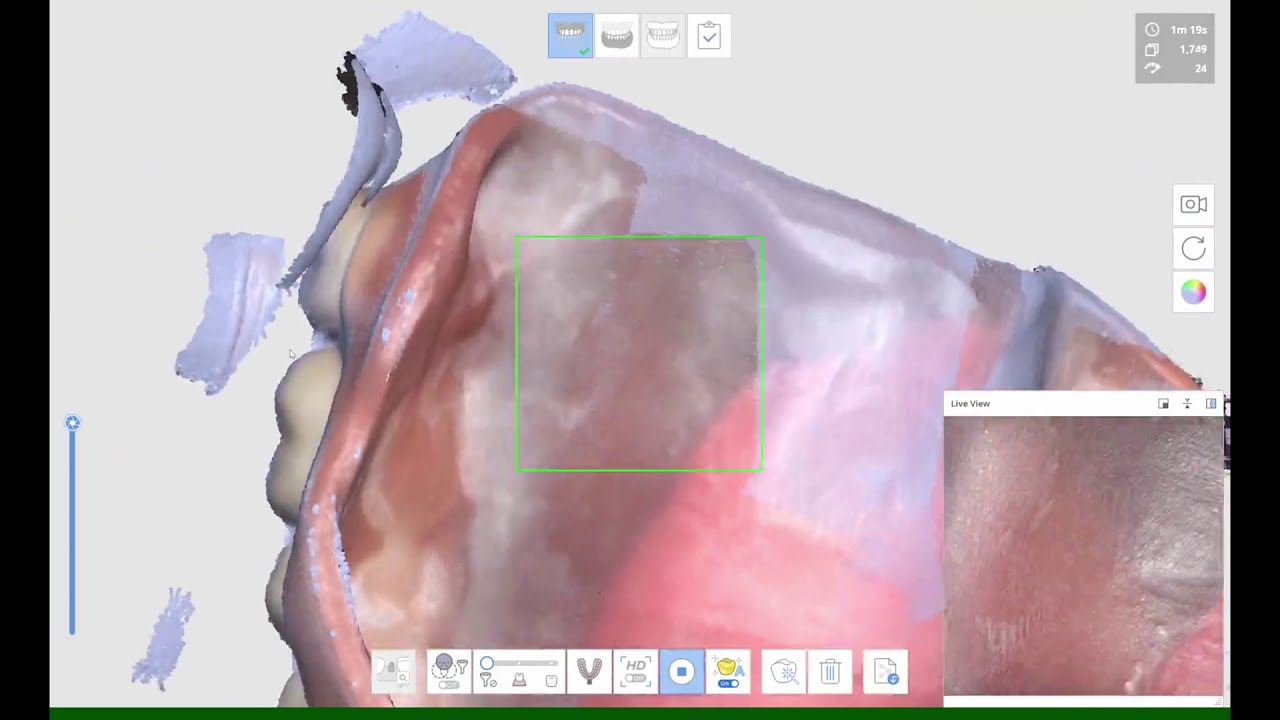 Denture Scan with Medit i500 - YouTube