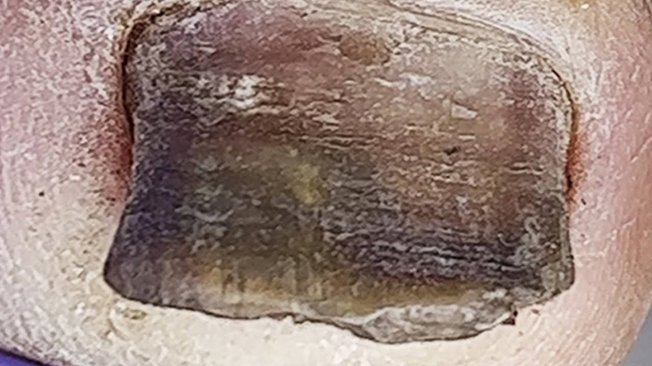 The toenails of the old man turned black, a complete transformation ...