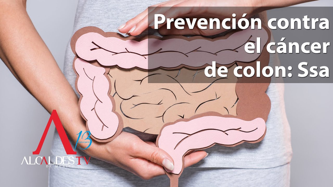 Prevención contra el cáncer de colon: Ssa - YouTube