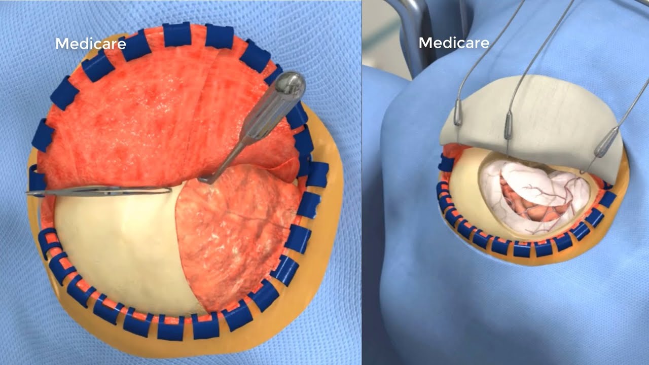 Craniotomy - YouTube
