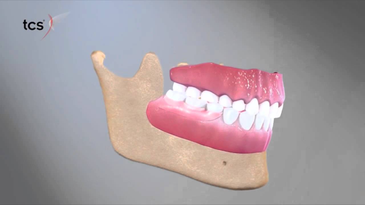 TCS Partial Patient Education - YouTube