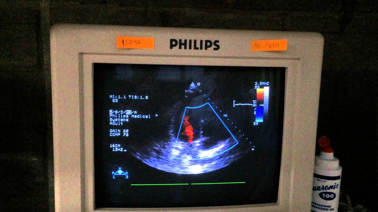 Philips Sonos 7500 Ultrasound 1 - YouTube