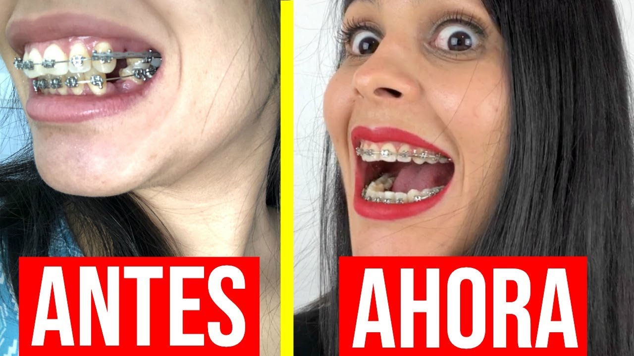 Me SACARON 7 MUELAS 🦷 | La HISTORIA de mis BRACKETS - YouTube
