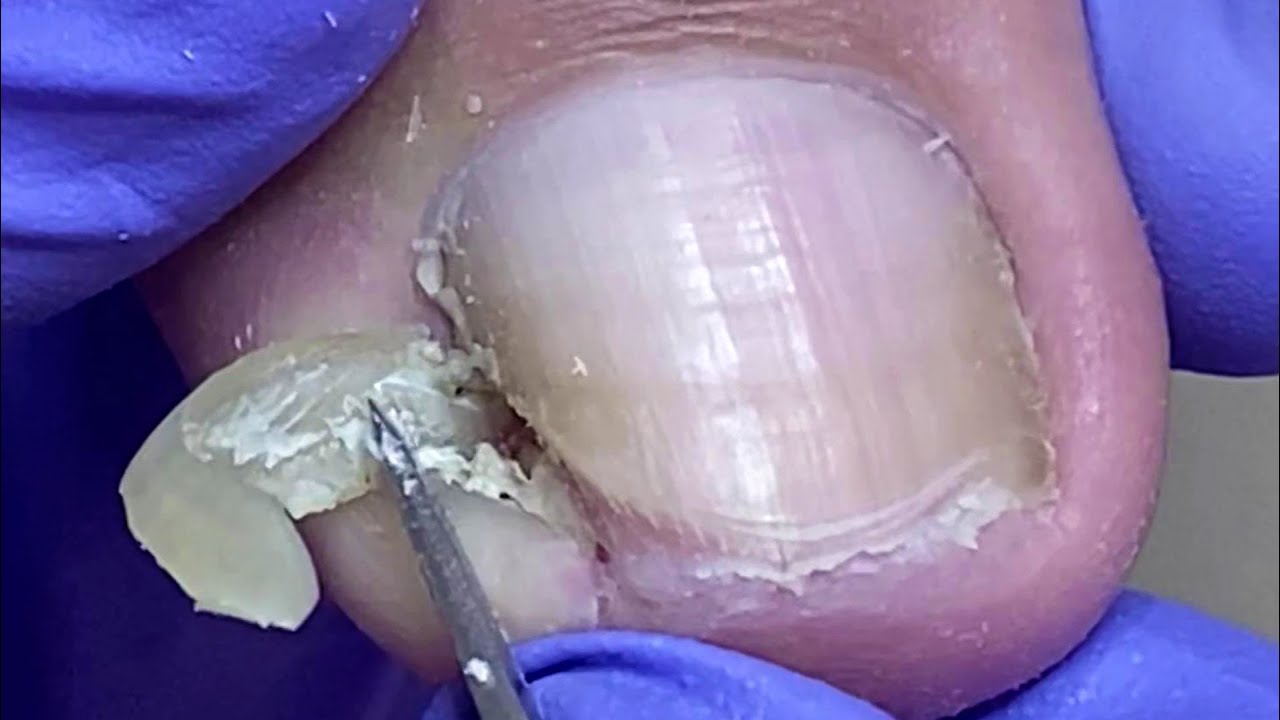 Super thick black nails, dug out layers of black mud【Doctor Liu ...