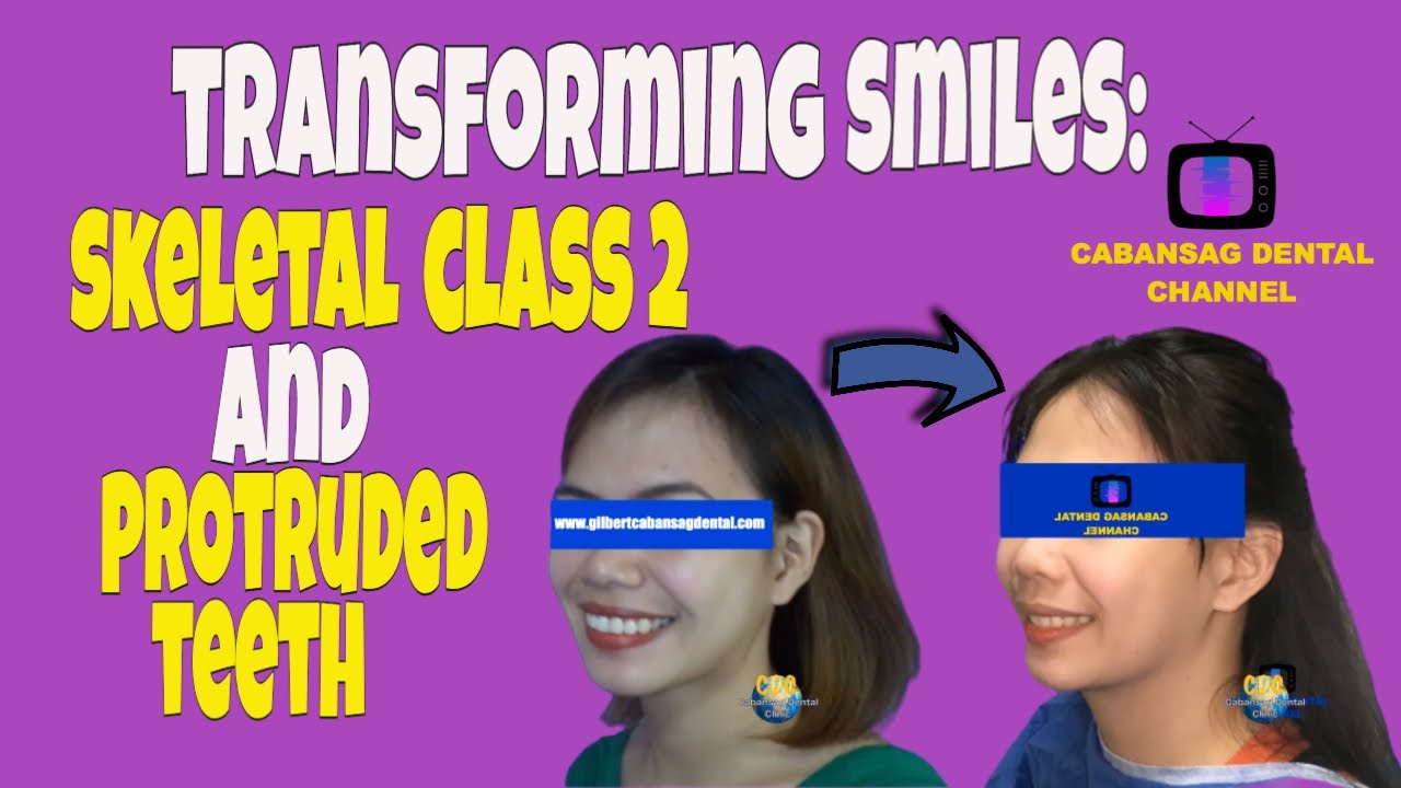skeletal Class 2 with prominent front teeth: transforming smiles by ...