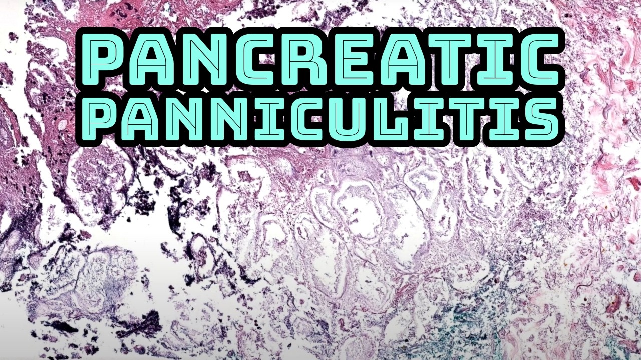 Pancreatic Panniculitis (fat necrosis with calcification saponification ...