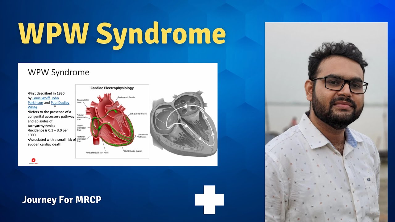 WPW Syndrome Explanation - YouTube