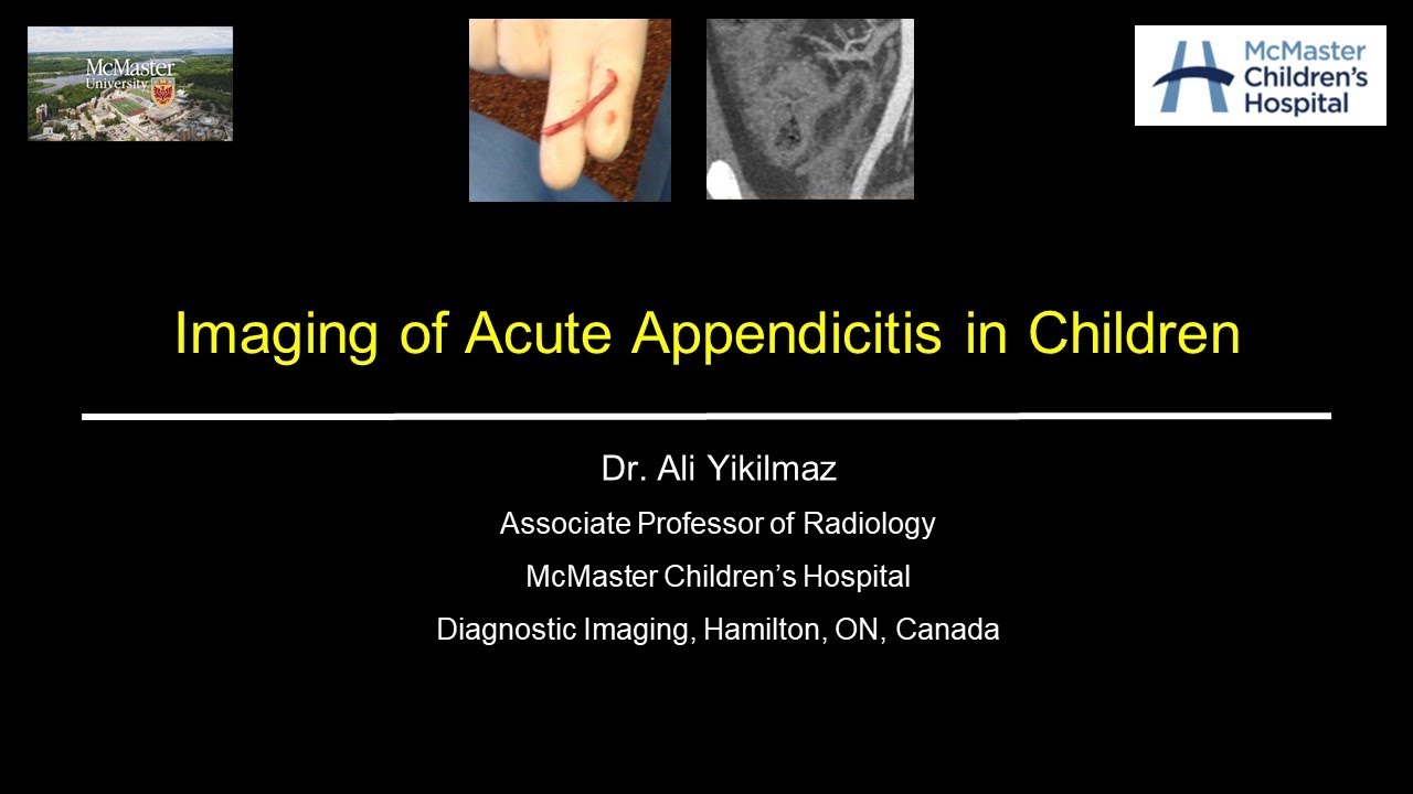 Acute Appendicitis - YouTube