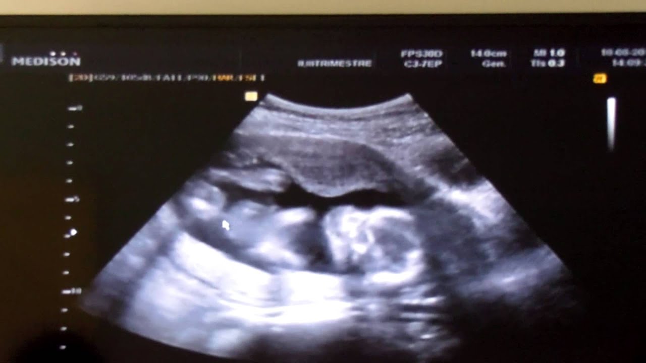 Ultrassom 17 semanas 4 dias MENINA! - YouTube
