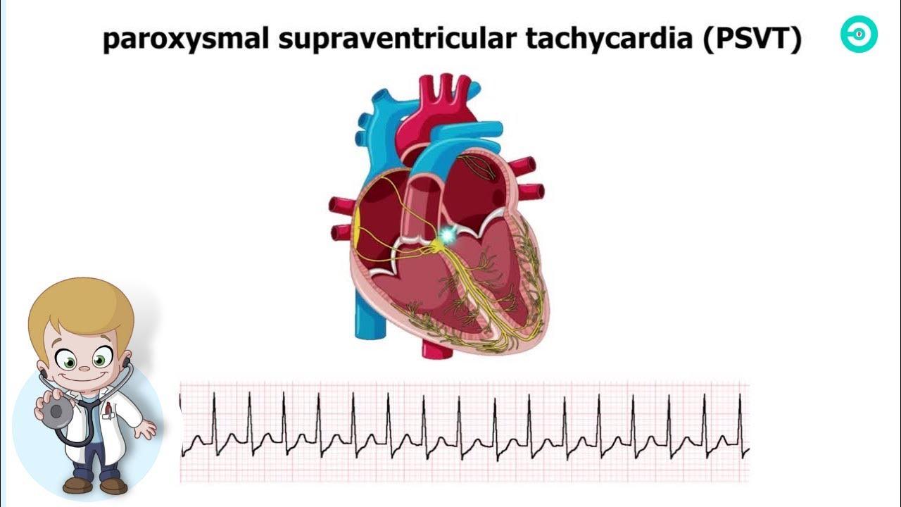 Types and ECG features of Supraventricular Tachycardia (SVT) - YouTube