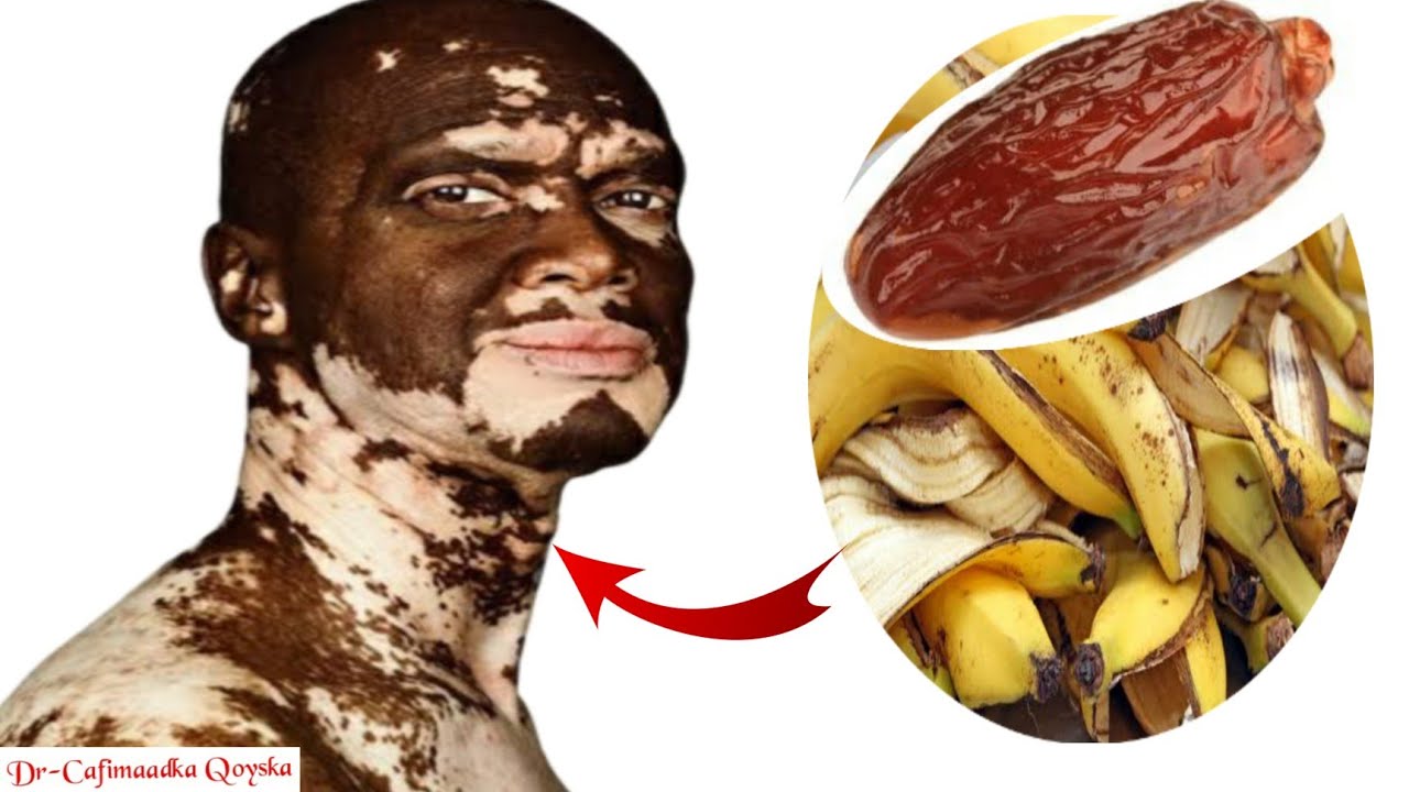 Xanuunka BARASKA Sida Dabeecika Ah Ee Loo Daweeyo - YouTube