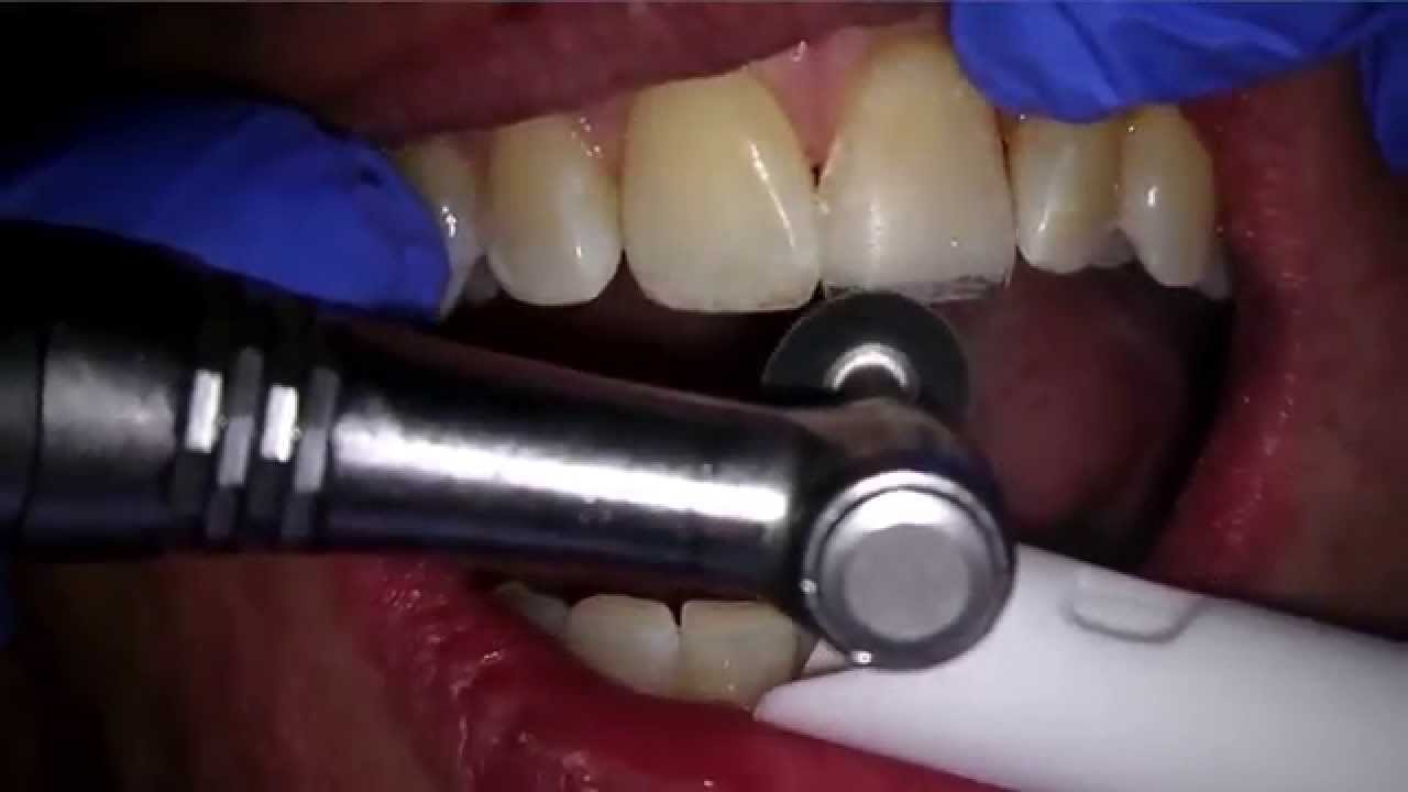 Fixing/Repairing Large Tooth Fracture - YouTube
