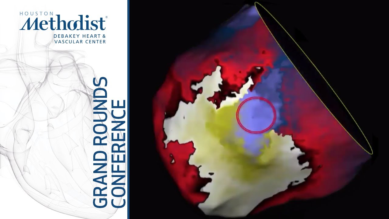 New Insights into Human VT: Anatomy & Physiology of a Public Enemy ...