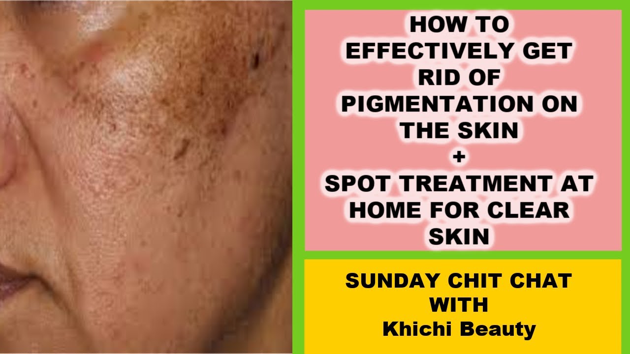 HOW TO EFFECTIVELY GET RID OF PIGMENTATION ON THE SKIN + SPOT TREATMENT ...